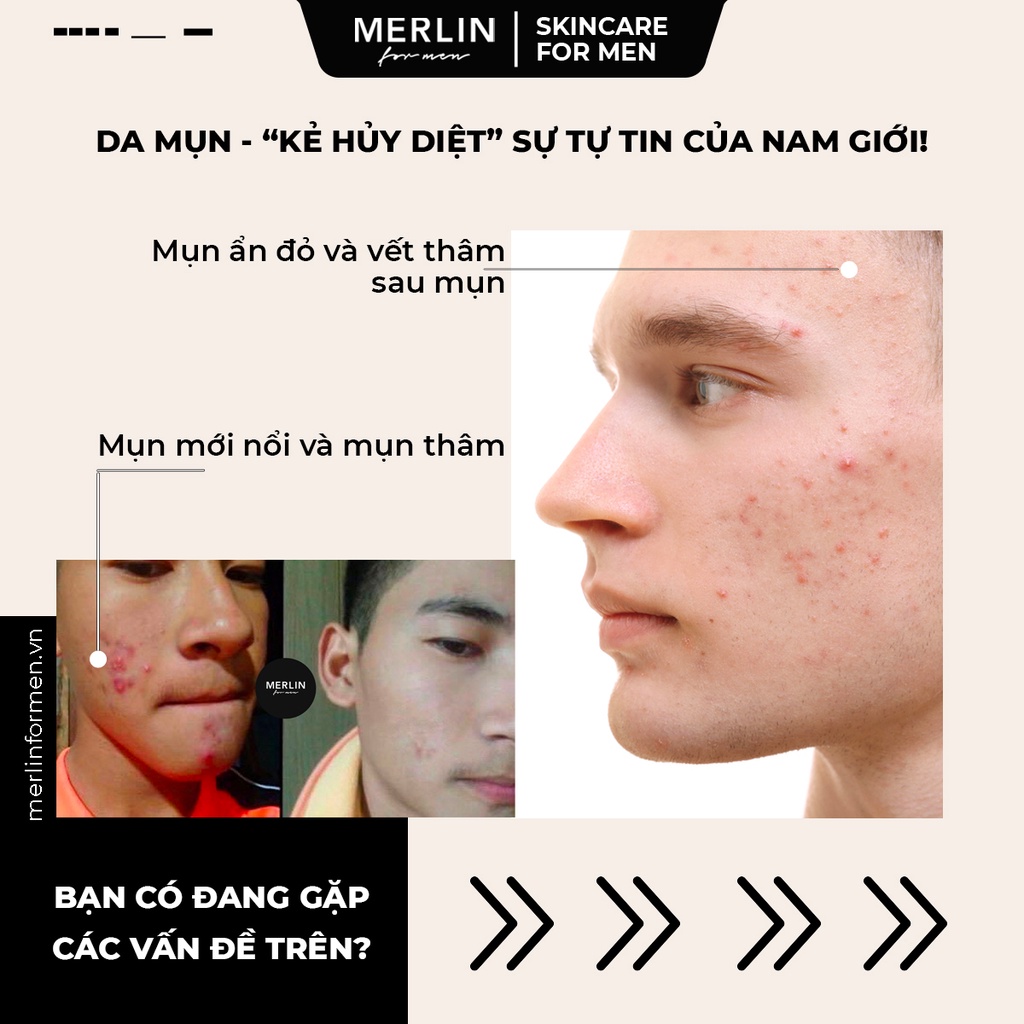 Mua Kem chấm mụn và mờ thâm nam Merlin Nano Curcumin 6h, hỗ trợ giảm ...