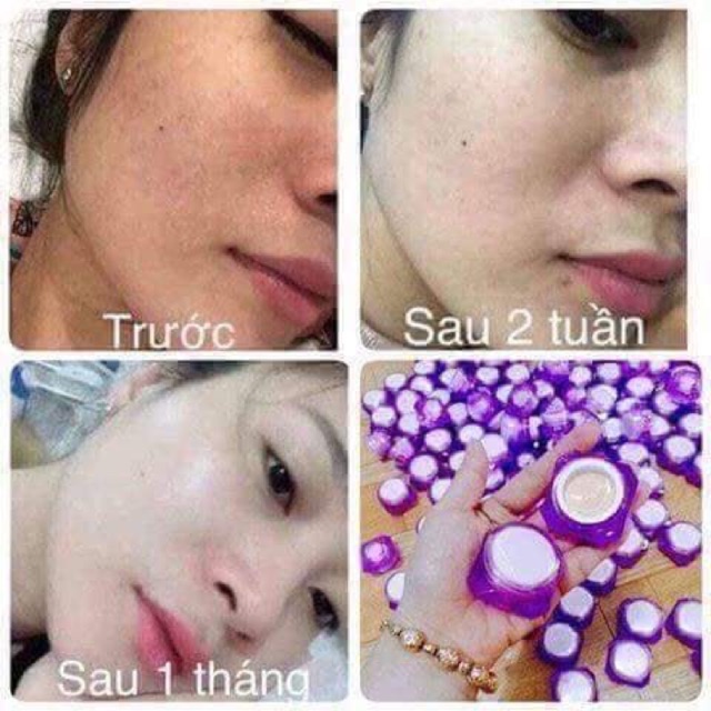 Các loại kem trị mụn 2c có tốt không