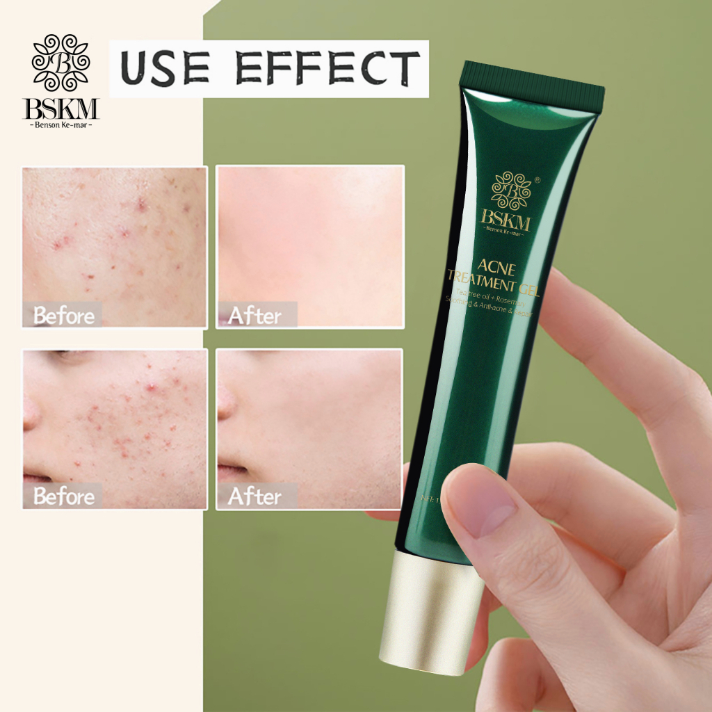 Mua BSKM Bộ 3 Serum Cải Thiện Mụn Gel Kem Tinh Dầu Tràm Trà Úc Giảm Mụn ...